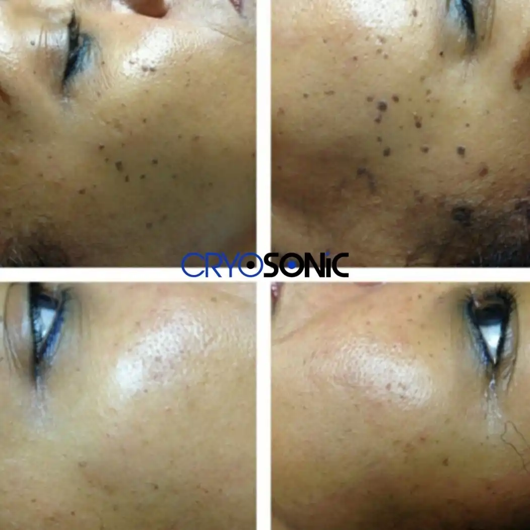 Cryotherapy 4 Dark Skin: Risks & Safe Protocols Featherstone